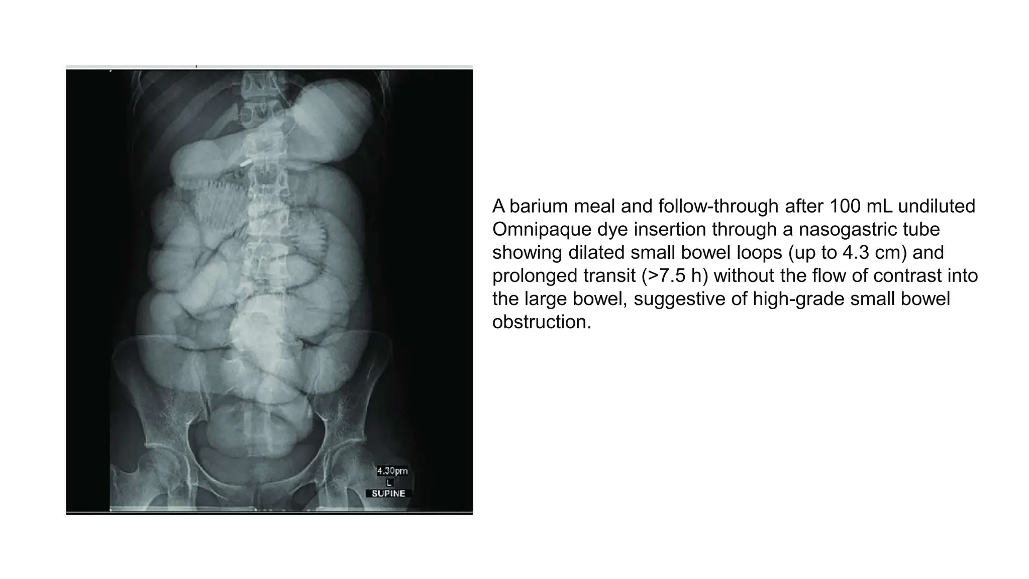 SMALL BOWELL OBSTRUCTION IN VIRGIN ABDOMEN.pptx