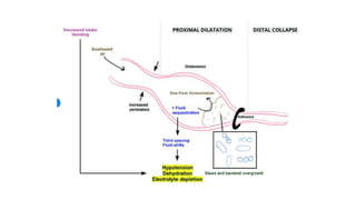 SMALL BOWELL OBSTRUCTION IN VIRGIN ABDOMEN.pptx