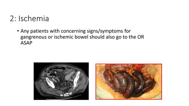 SMALL BOWELL OBSTRUCTION IN VIRGIN ABDOMEN.pptx
