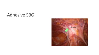 SMALL BOWELL OBSTRUCTION IN VIRGIN ABDOMEN.pptx