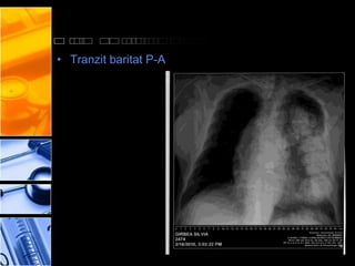 Hernie diafragmatica anterioara | PPT