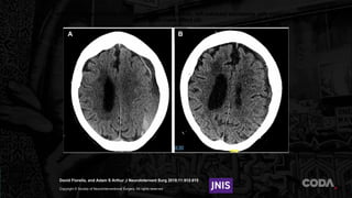 Subdural Haemorrhage and MMA embolisation | PDF