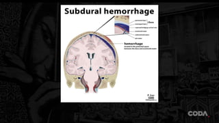 Subdural Haemorrhage and MMA embolisation | PDF