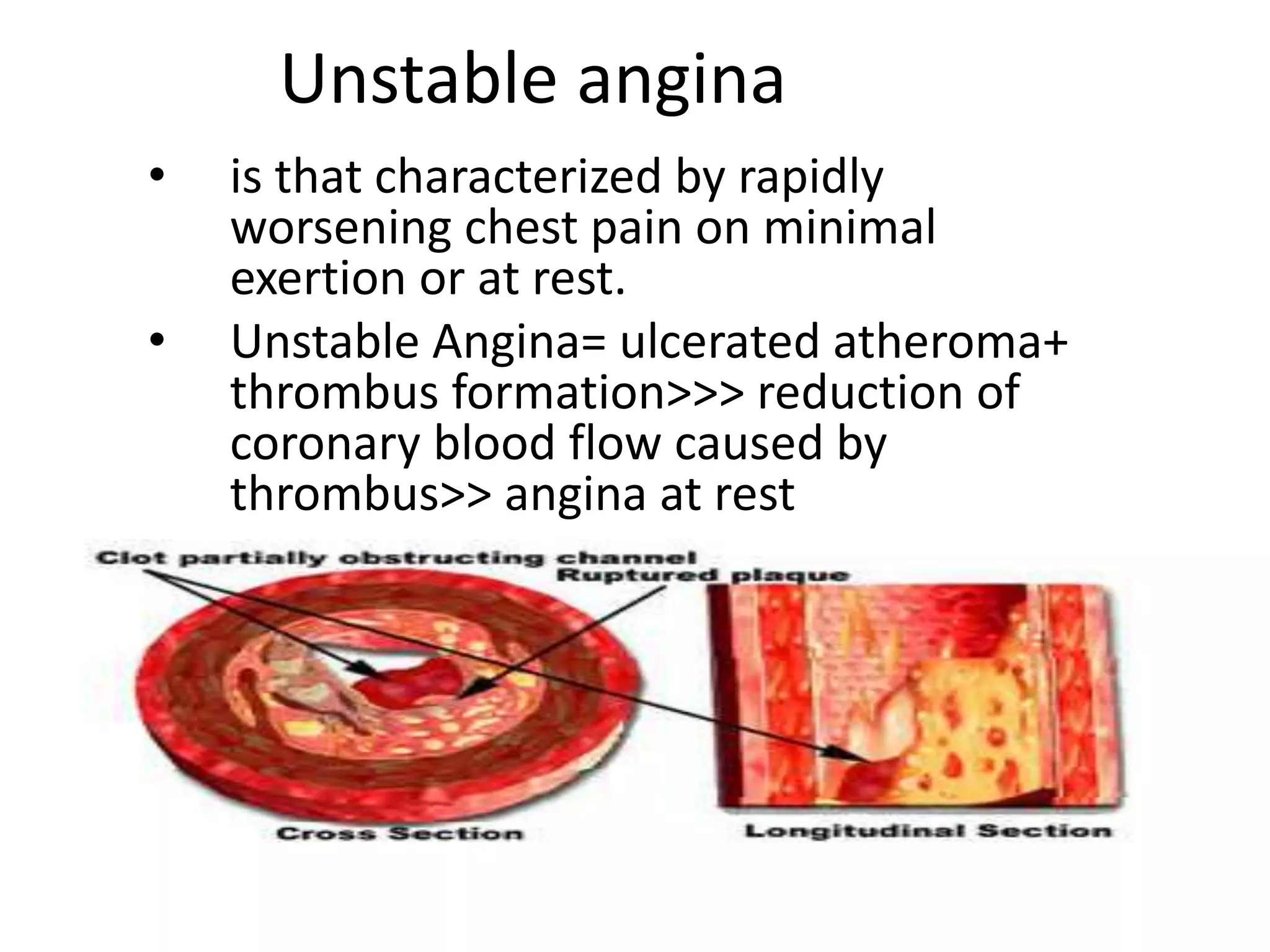 Angina Pectoris | PPTX