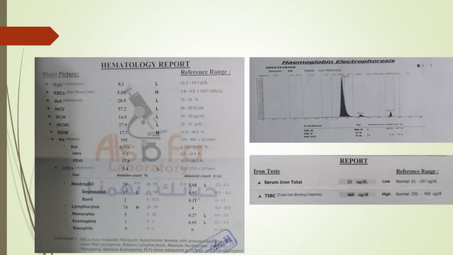 complete blood count analysis and blood disease investigation | PDF ...