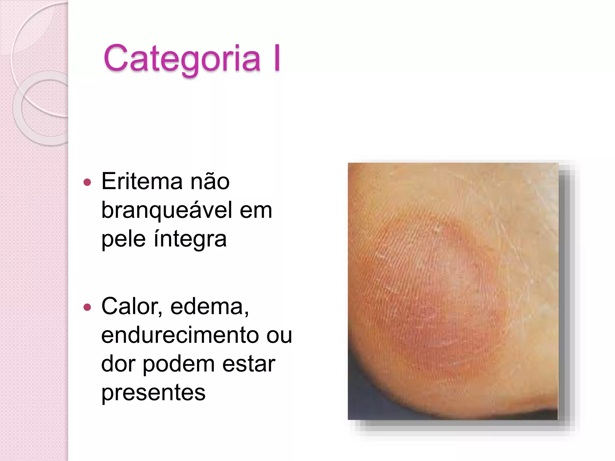 Avaliação e tratamento de feridas - CBCENF | PPTX