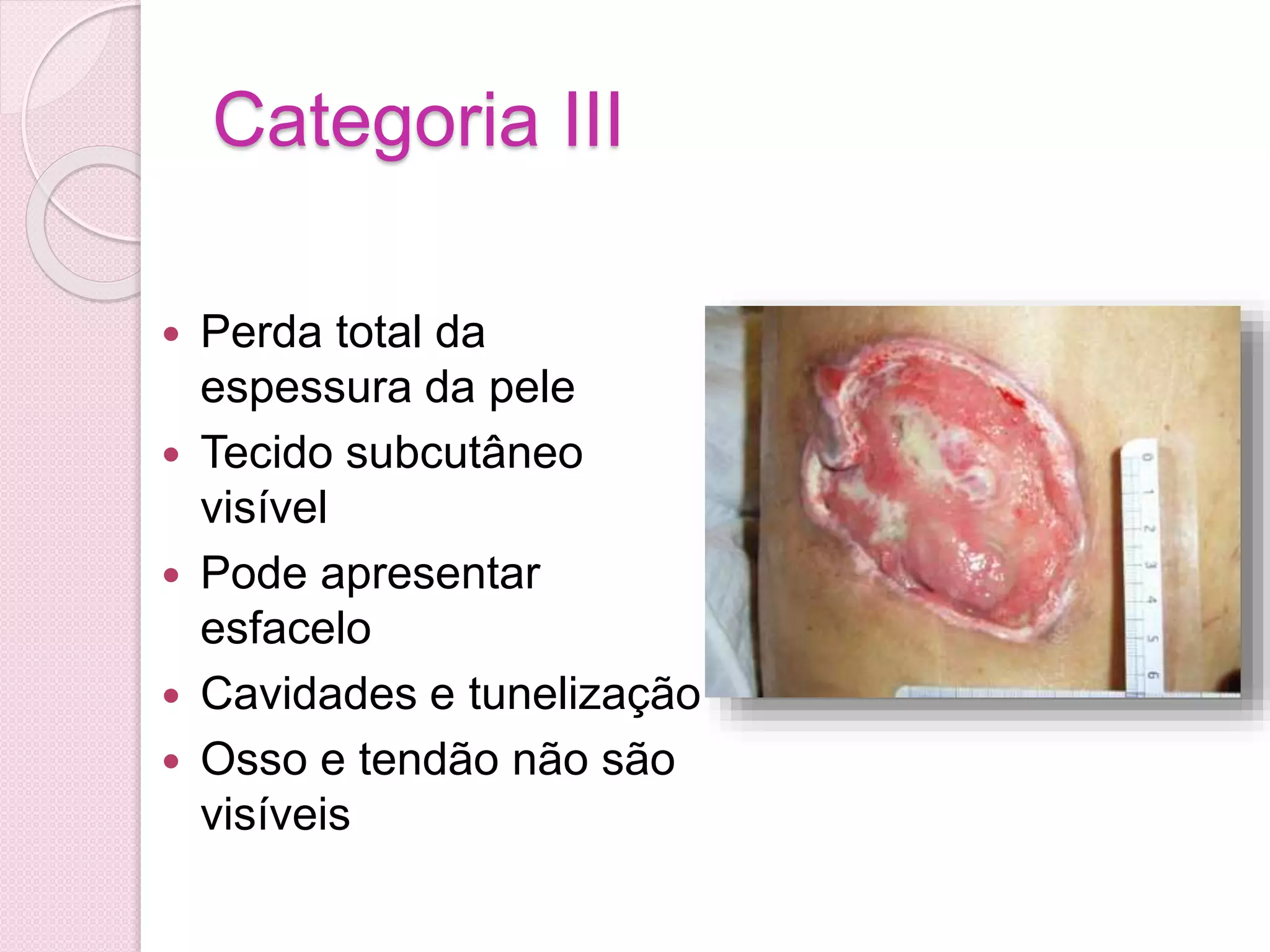 Avaliação e tratamento de feridas - CBCENF | PPTX