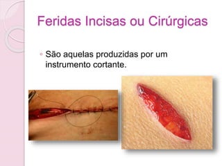 Avaliação e tratamento de feridas - CBCENF | PPT