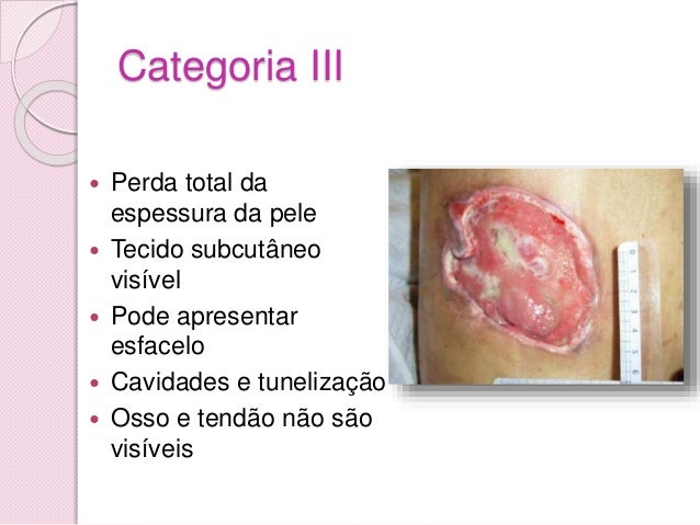 Avaliação e tratamento de feridas - CBCENF