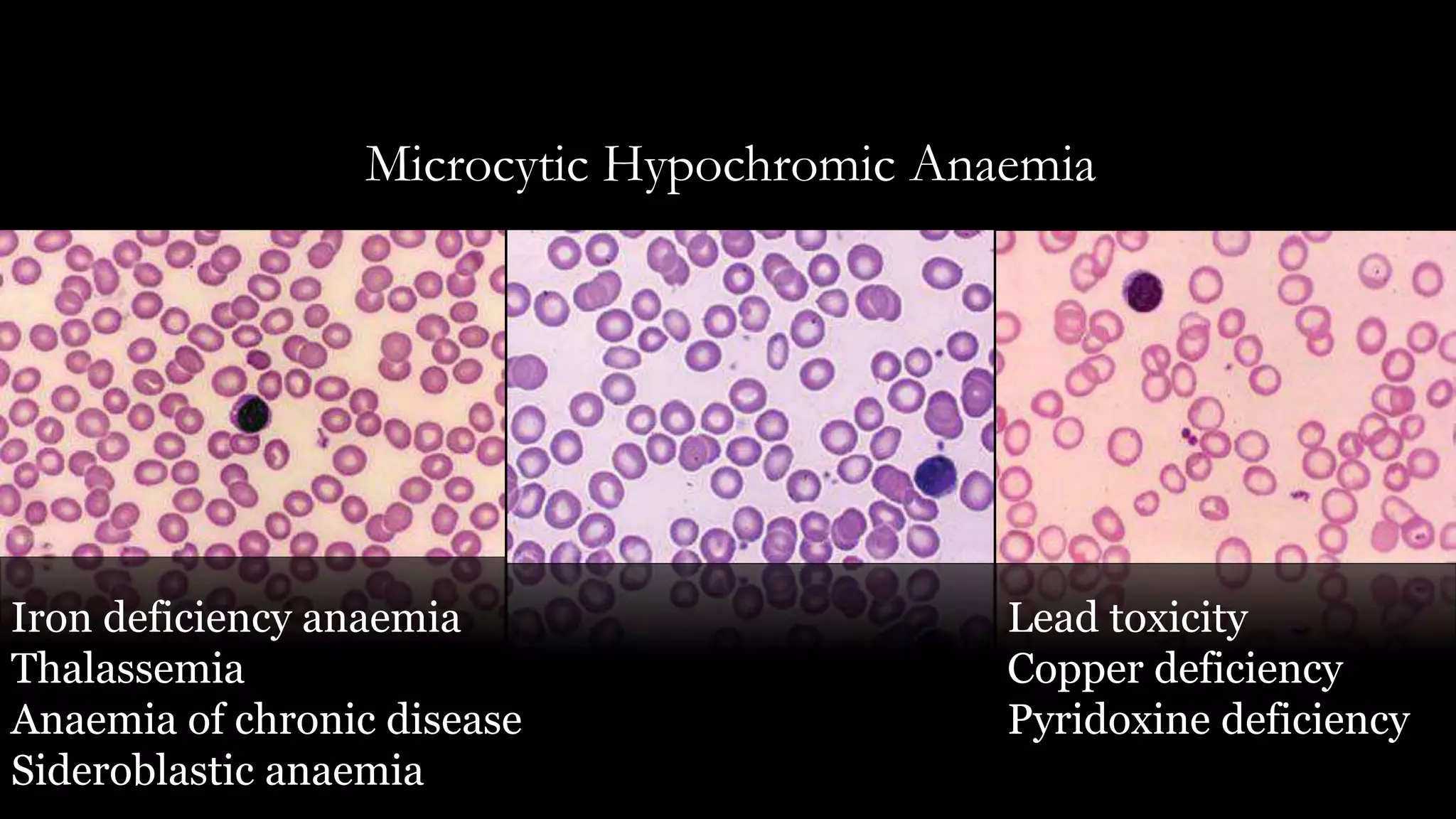 Complete Blood Count Interpretation | PPTX