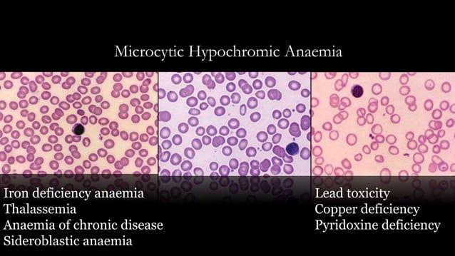 Complete Blood Count Interpretation | PPTX | Blood Disorders | Diseases ...
