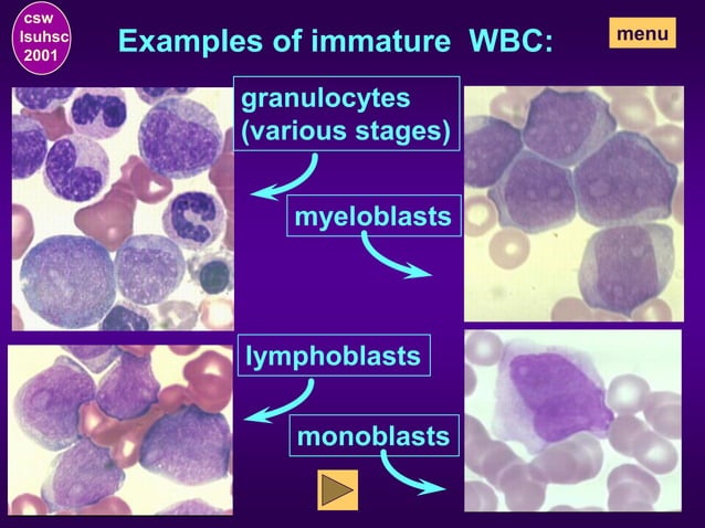 CBC Part 2 - WBC Differential & Morphology.pdf | Blood Disorders ...