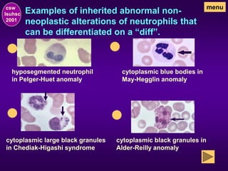Hyposegmented Neutrophils