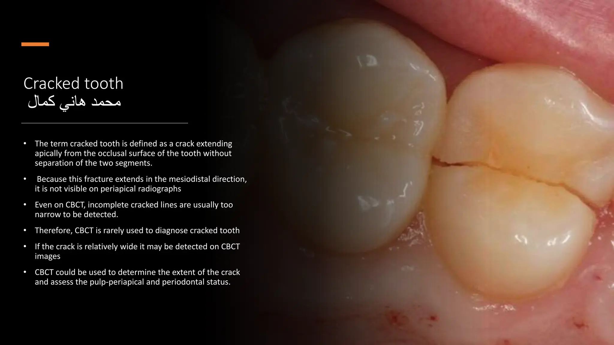 CBCT in dental trauma__.pptx explain dental trauma in cbct | PPTX