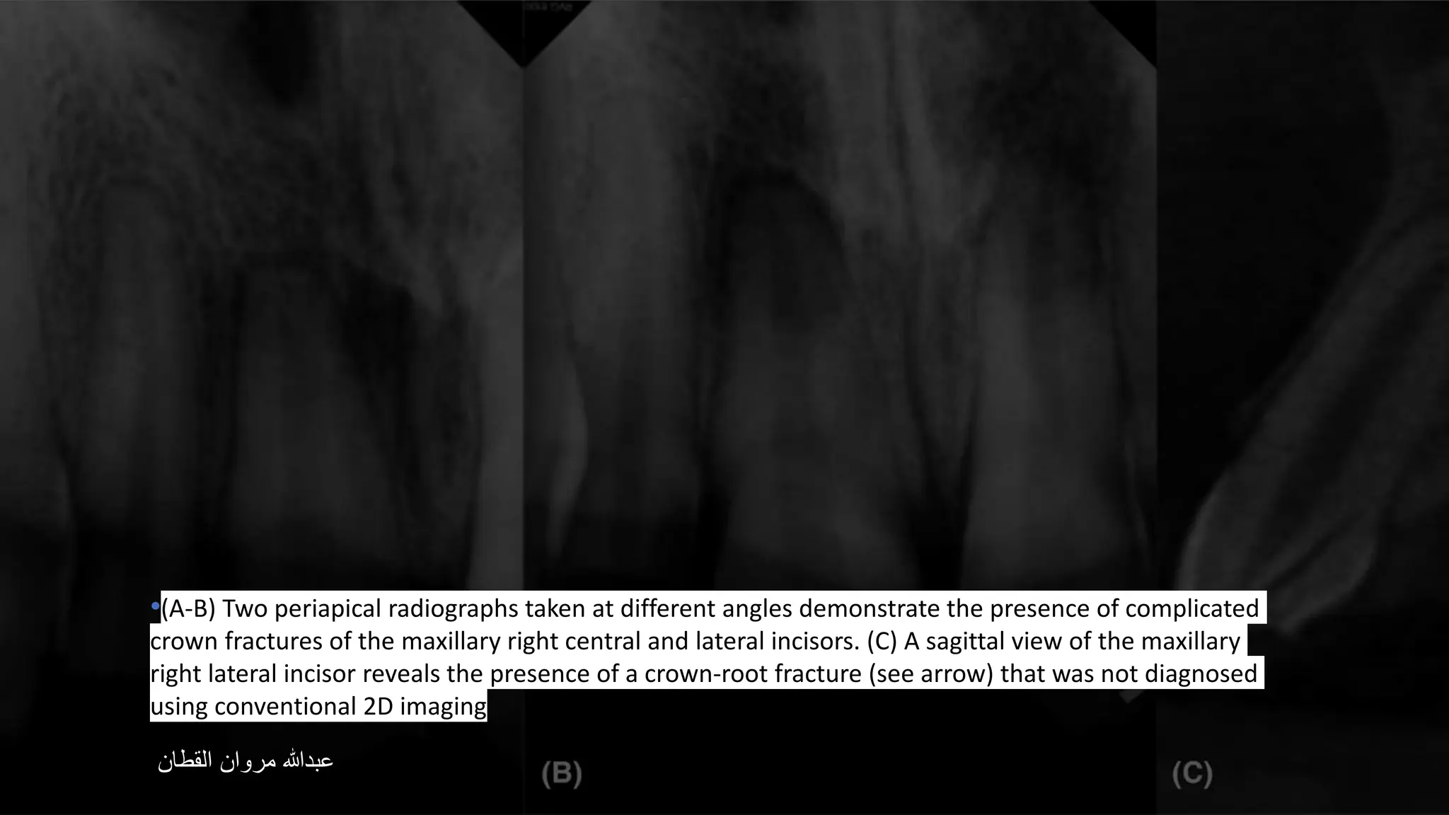 CBCT in dental trauma__.pptx explain dental trauma in cbct | PPTX