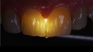 CBCT in dental trauma__.pptx explain dental trauma in cbct | PPTX