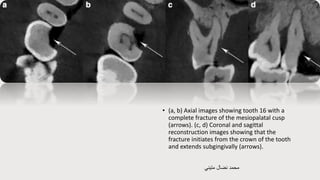 CBCT in dental trauma__.pptx explain dental trauma in cbct | PPTX