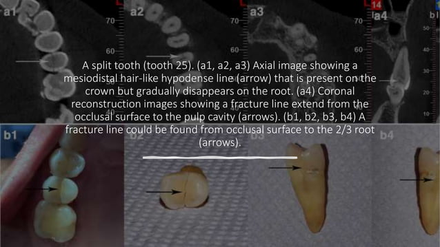 CBCT in dental trauma__.pptx explain dental trauma in cbct | PPT