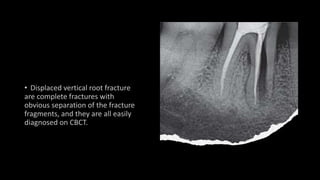CBCT in dental trauma__.pptx explain dental trauma in cbct | PPTX