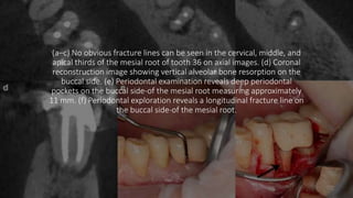 CBCT in dental trauma__.pptx explain dental trauma in cbct | PPTX