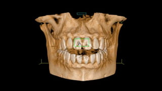 CBCT in dental trauma__.pptx explain dental trauma in cbct | PPTX