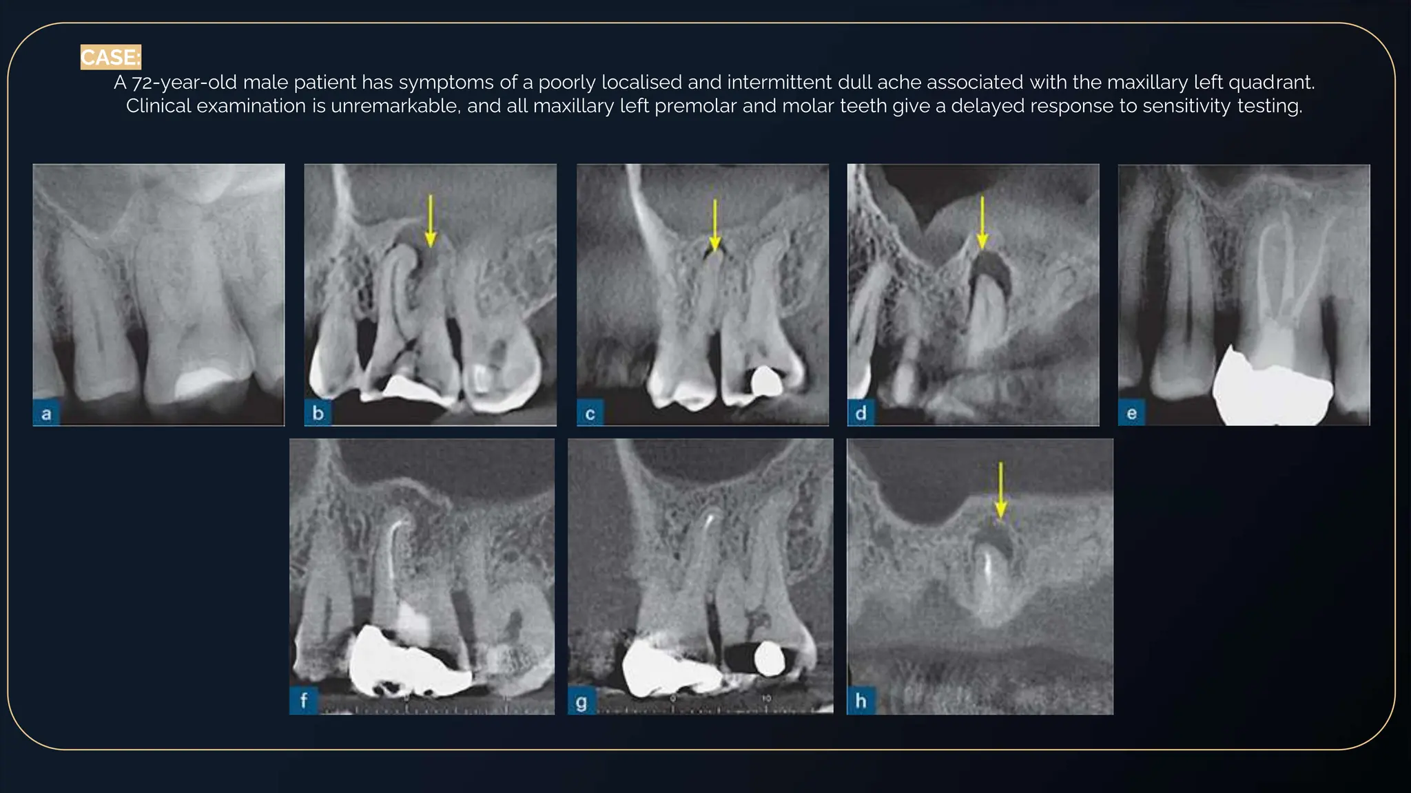 CBCT in Endodontics, Uses, Advanatges, Disadvantages, and Recent Advancements.pptx | Dental ...