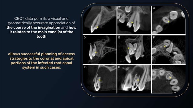 CBCT in Endodontics, Uses, Advanatges, Disadvantages, and Recent ...