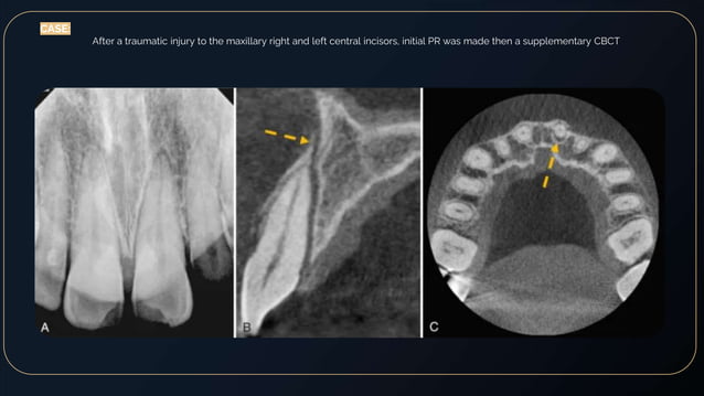 CBCT in Endodontics, Uses, Advanatges, Disadvantages, and Recent Advancements.pptx | Dental ...