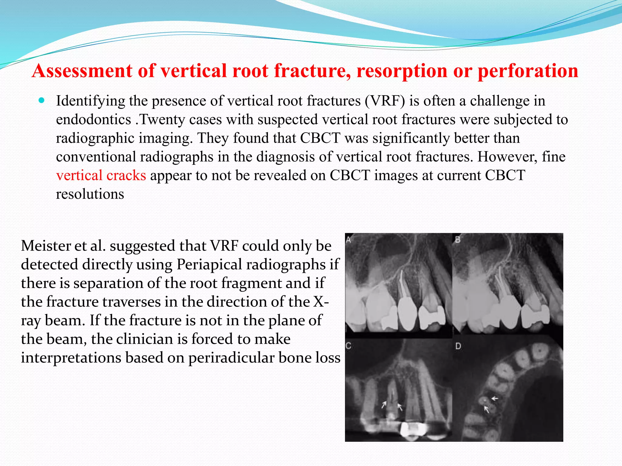 Cbct in endodontics ppt | PPTX