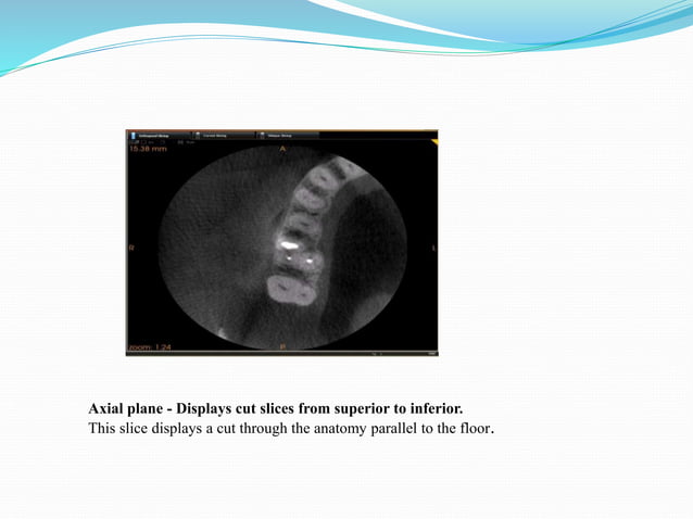 Cbct in endodontics ppt | PPTX