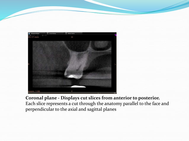 Cbct in endodontics ppt | PPTX