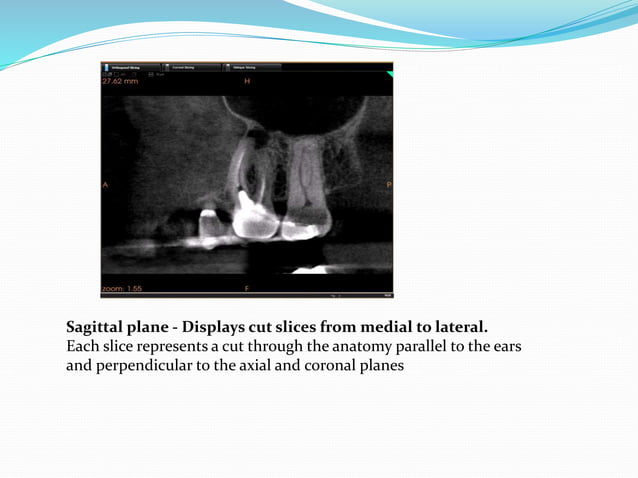 Cbct in endodontics ppt | PPTX