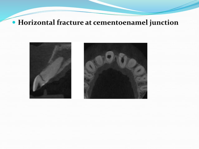Cbct in endodontics ppt | PPTX