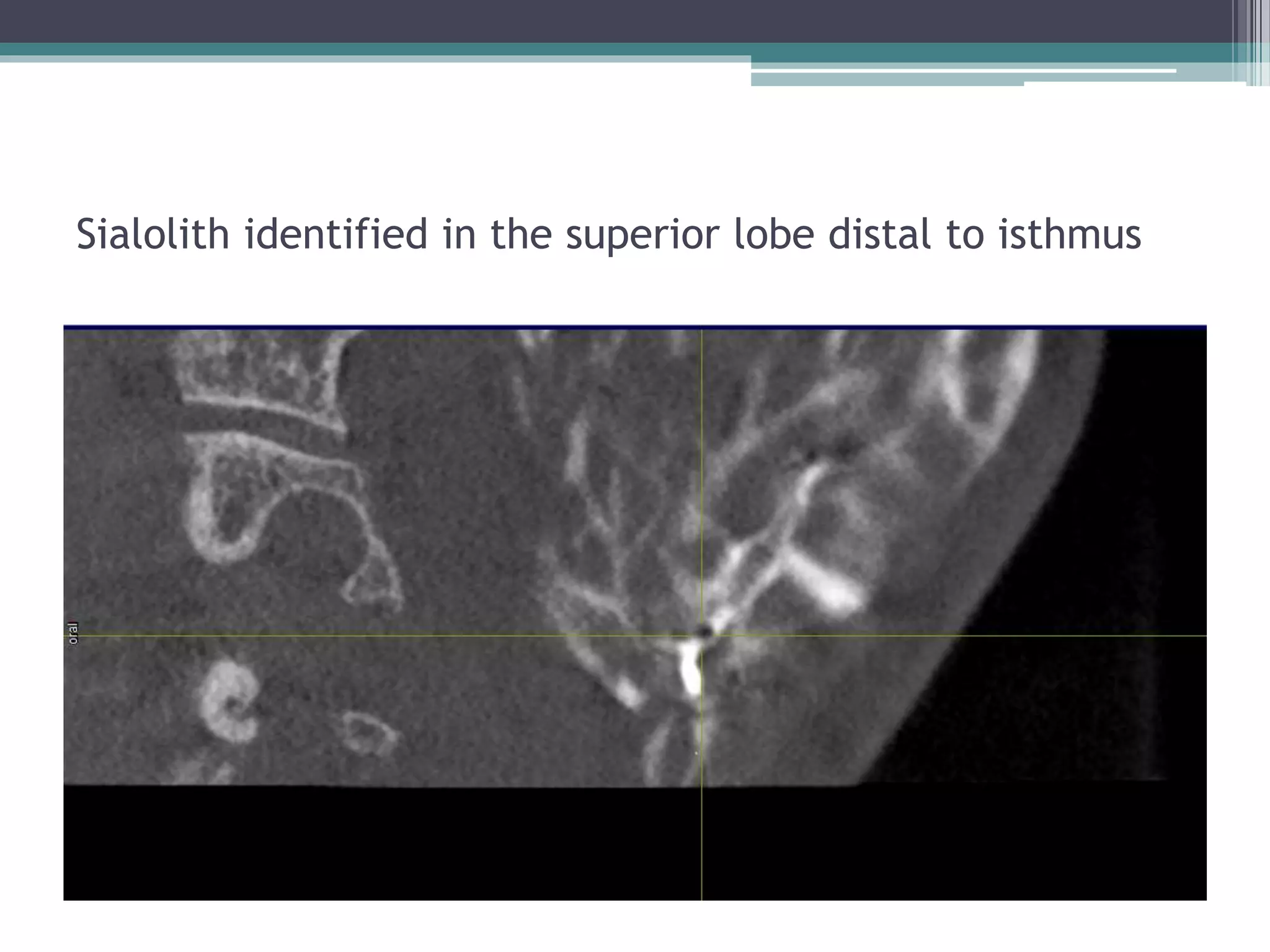 Cbct sialography | PPTX