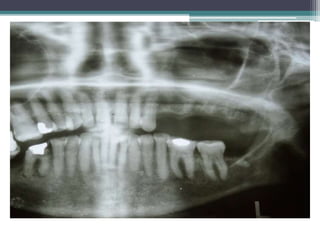 Cbct sialography | PPTX