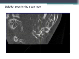 Cbct sialography | PPTX