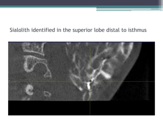 Cbct sialography | PPTX