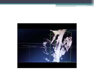 Cbct sialography | PPTX