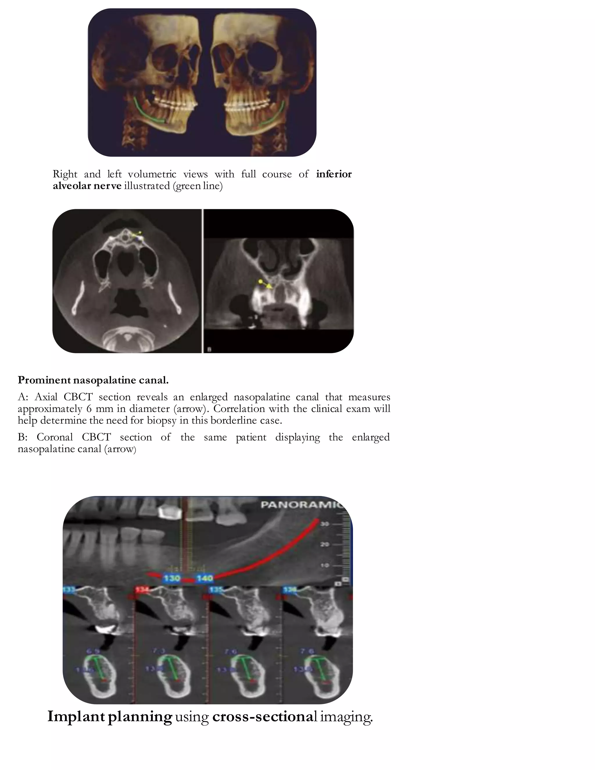 use of Cbct in dental implant | DOCX