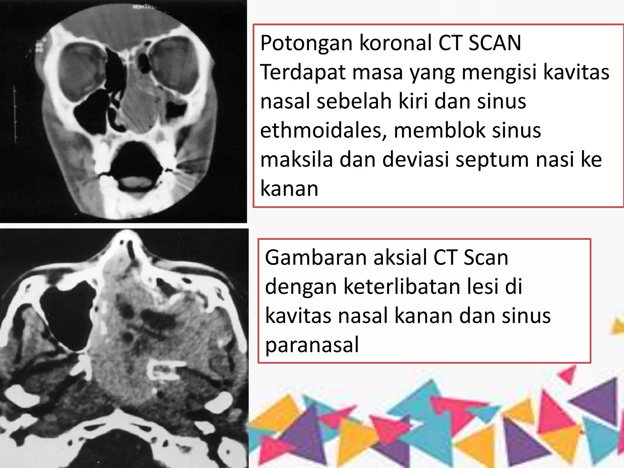 Cbd angiofibroma nasofaring belia (Gerasimos Hasiholan) | PPTX