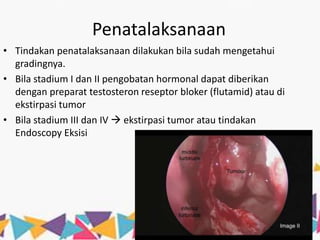 Cbd angiofibroma nasofaring belia (Gerasimos Hasiholan) | PPTX