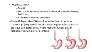 CBD Laryngopharyngeal Reflux | PPTX