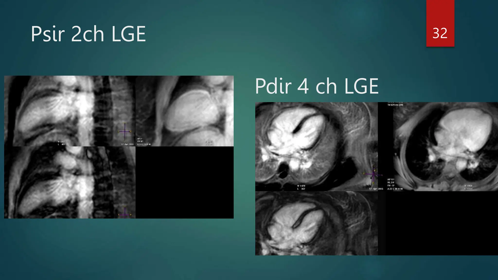 CBD myocarditis jhjhjhjhjhjhjhjhj (1).pptx