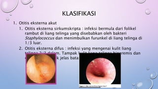 CBD otitis eksterna | PPTX