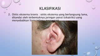 CBD otitis eksterna | PPTX