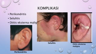 CBD otitis eksterna | PPTX