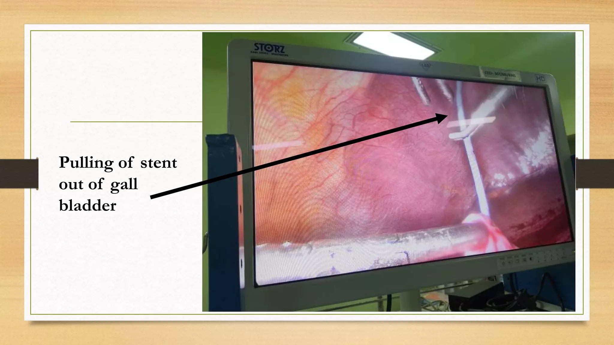 CBD Stent PPT.pptx