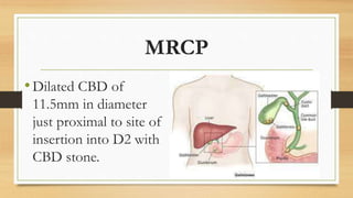 CBD Stent PPT.pptx | Digestive Disorders | Diseases and Conditions