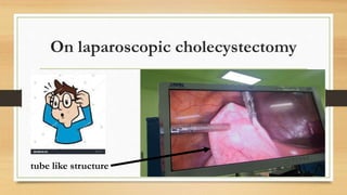 CBD Stent PPT.pptx