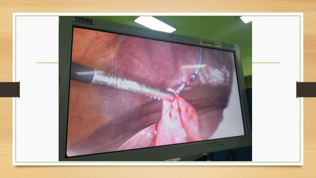 CBD Stent PPT.pptx